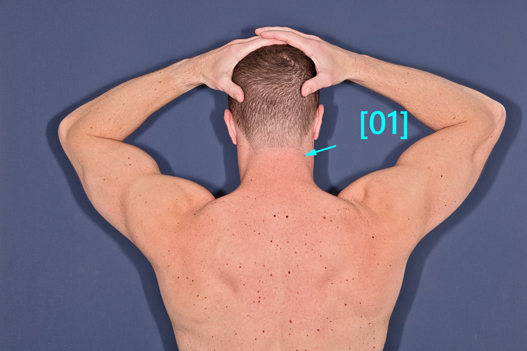 How would you manage this scalp lesion flagged by total body imaging?
