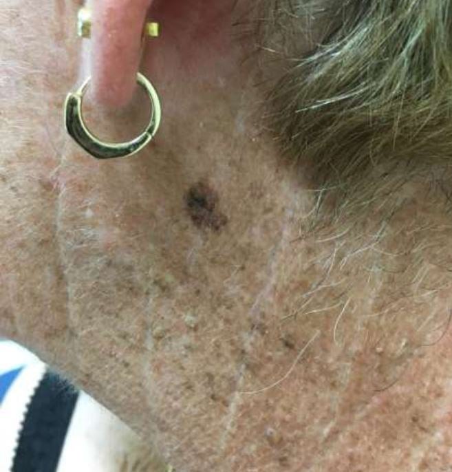How would you manage this lesion below the ear?