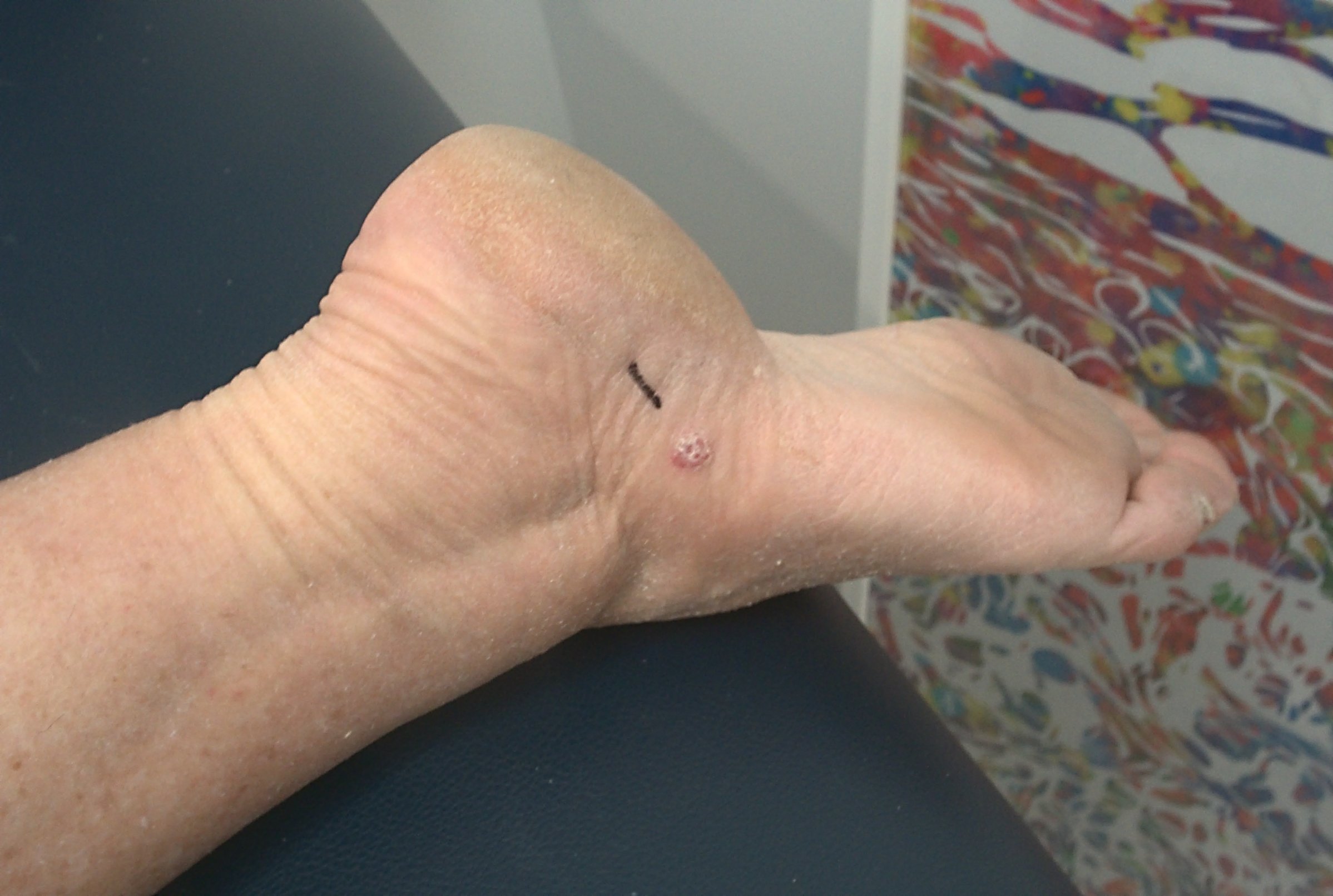 How would you manage this lesion on the medial foot?