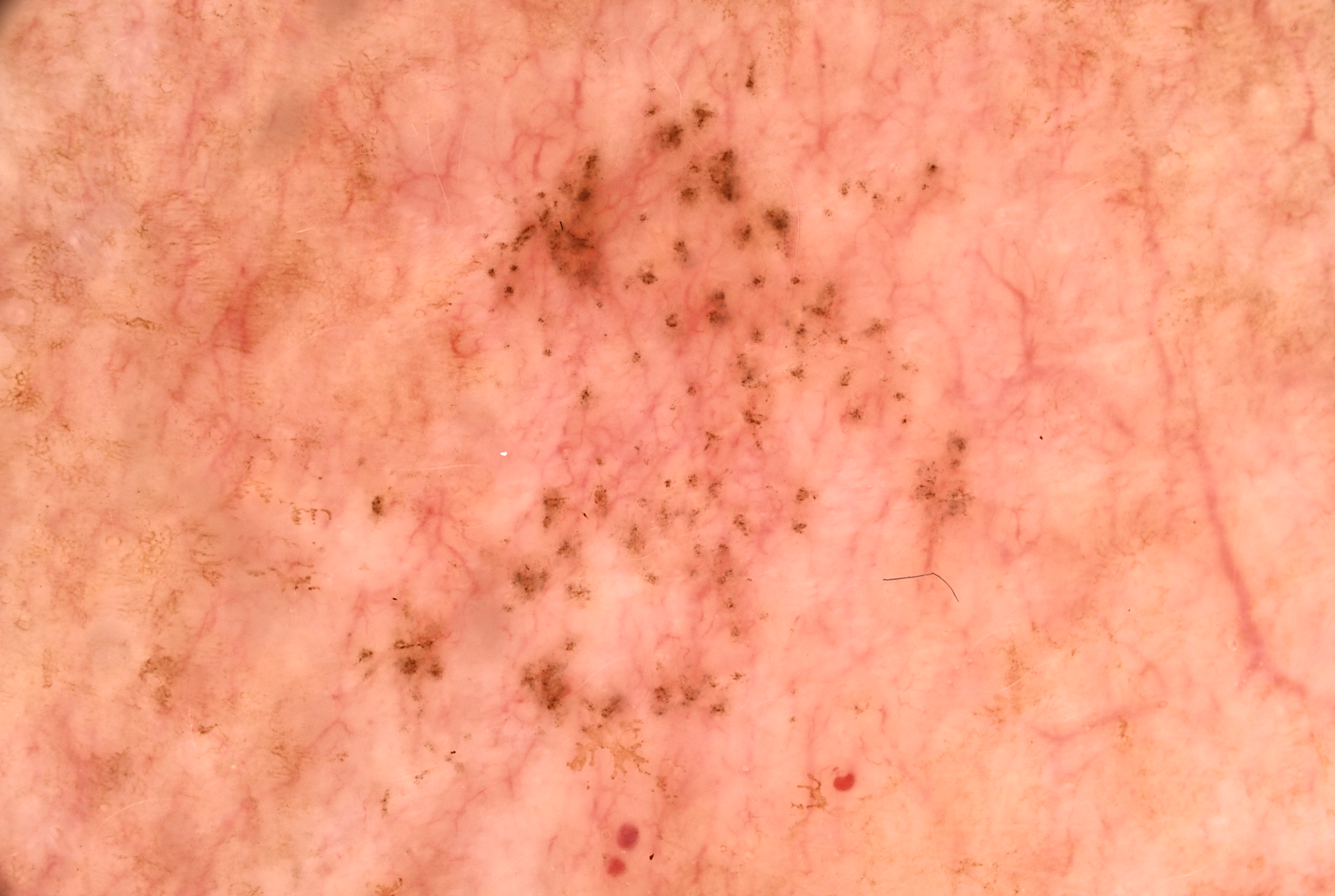 How would you treat this lesion on the chest?