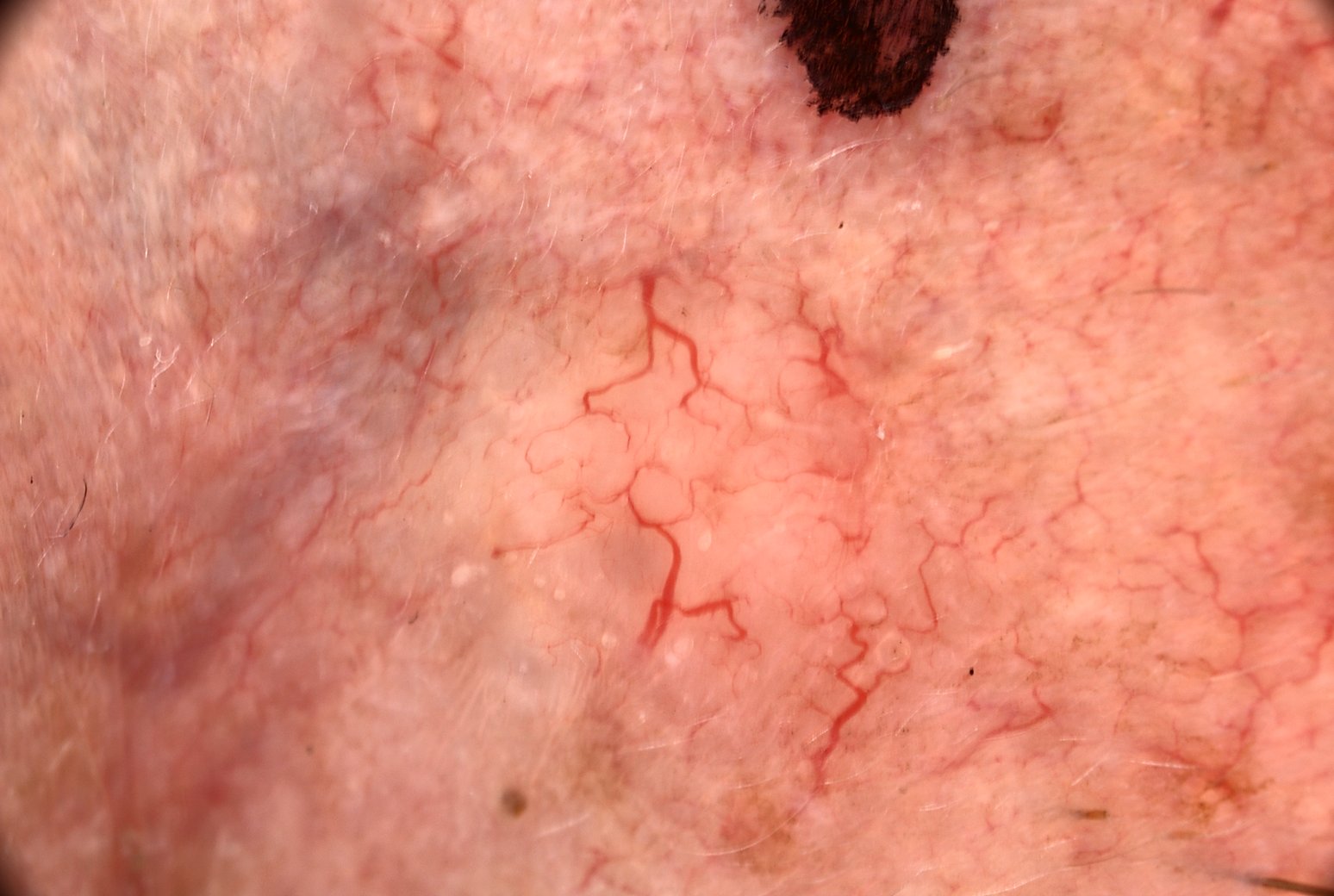 How would you manage this lesion on the eye?