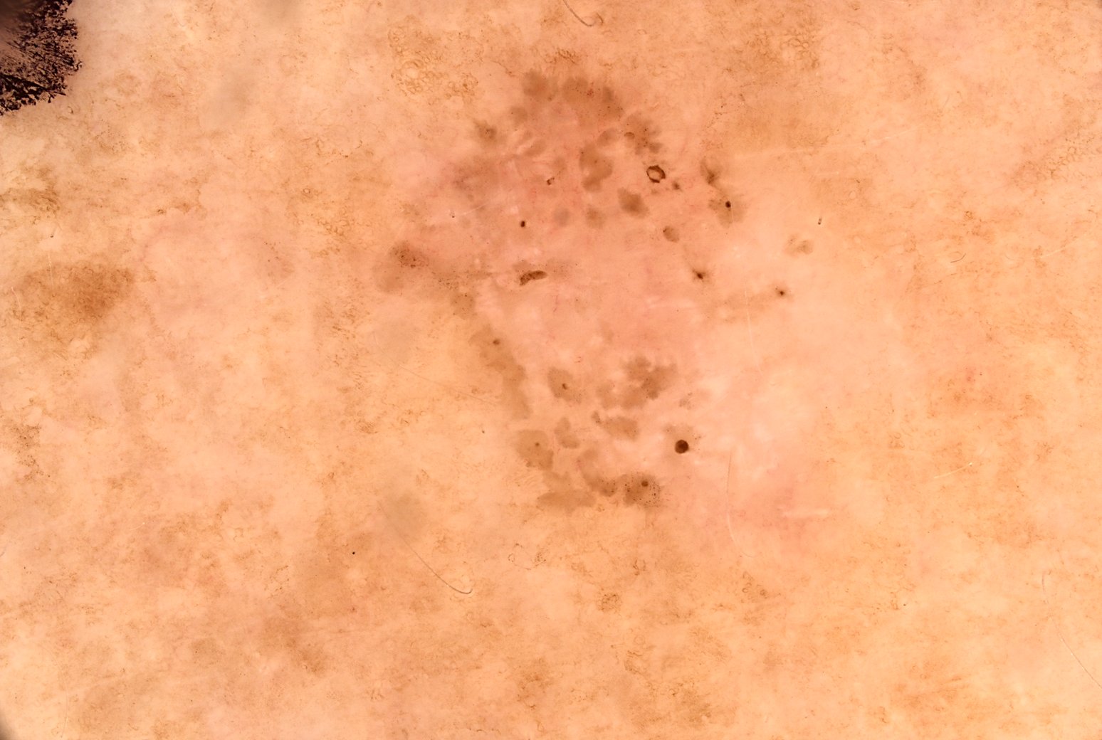 How would you treat this lesion on the lower limb? (Part 1 of 3)