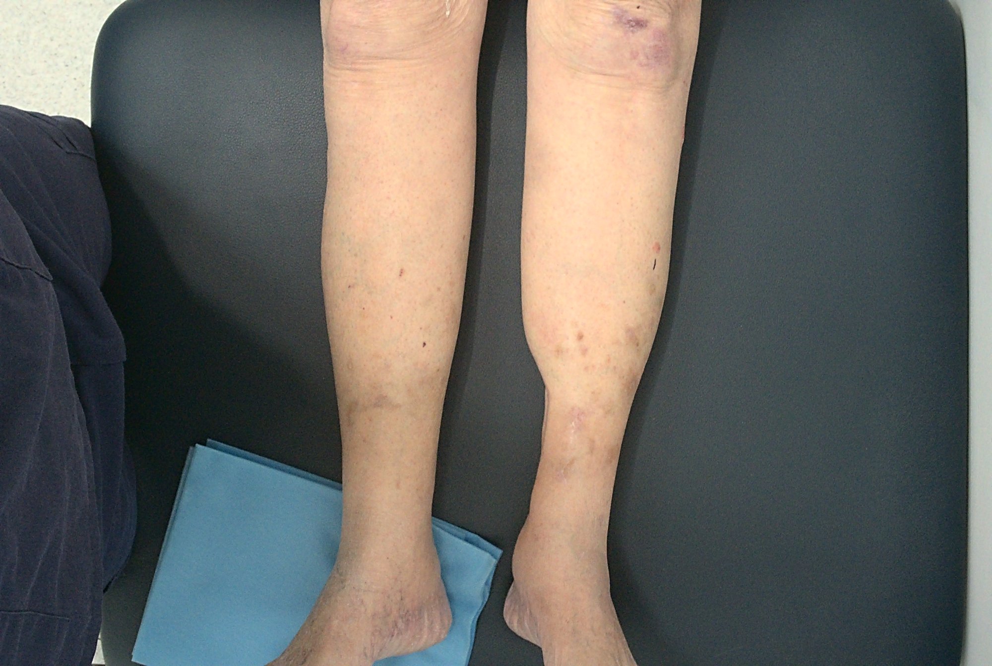 How would you manage this lesion on the leg of a 95-year-old?