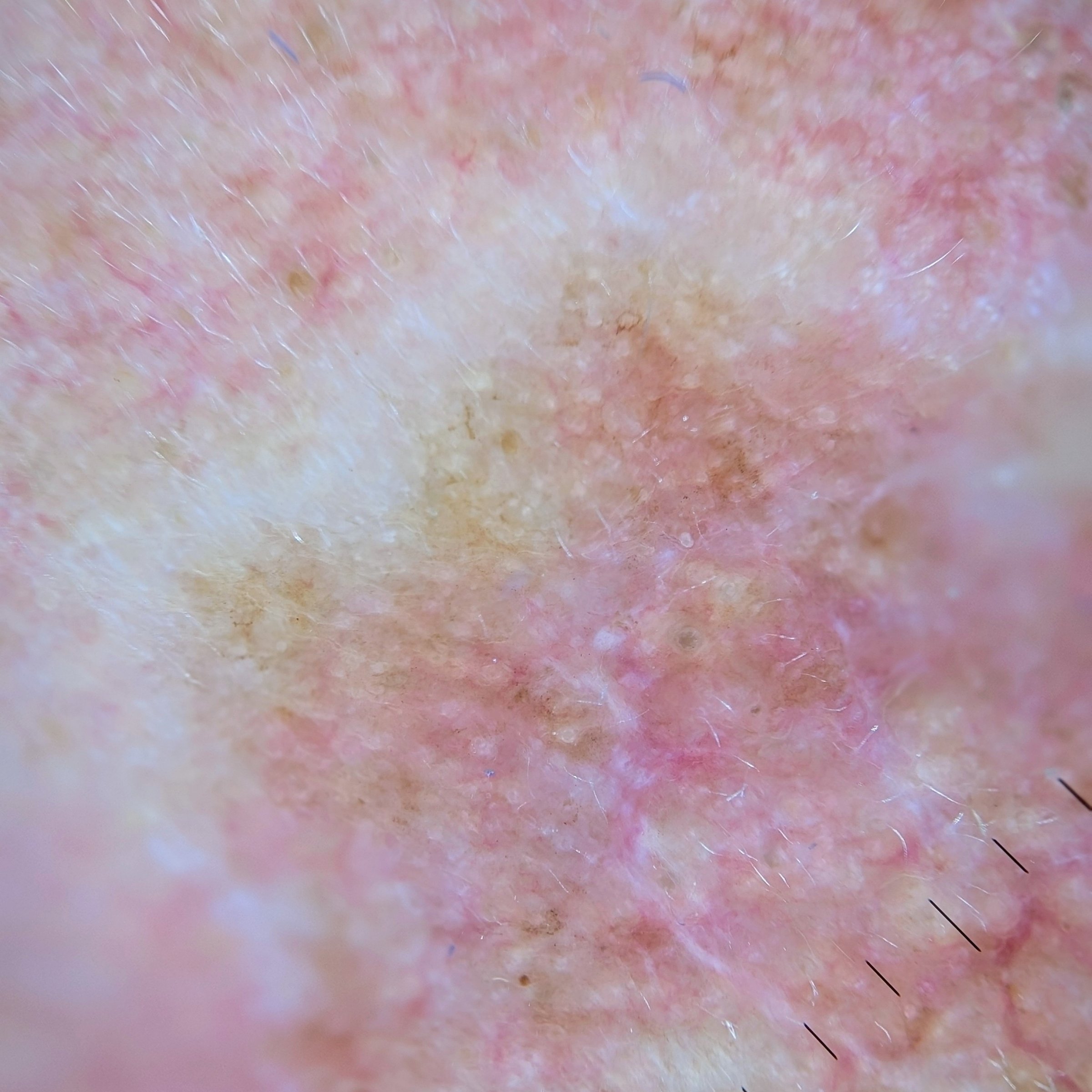 How would you manage this growing lesion on the nose?