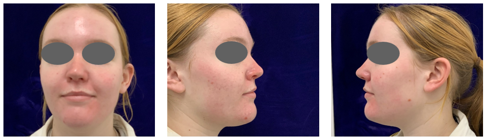 Dermatology case discussion: How would you manage this acne patient?