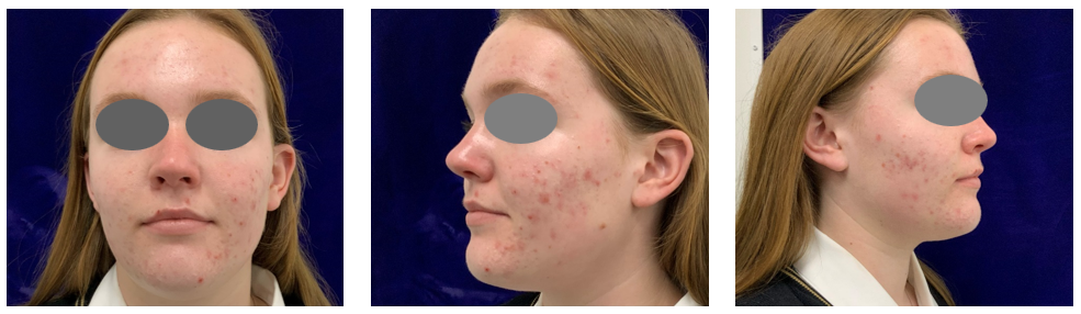 Dermatology case discussion: How would you manage this acne patient?
