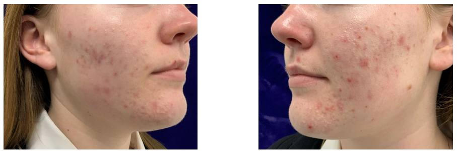 Dermatology case discussion: How would you manage this acne patient?