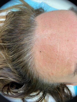 How would you manage this brown lesion on the forehead?