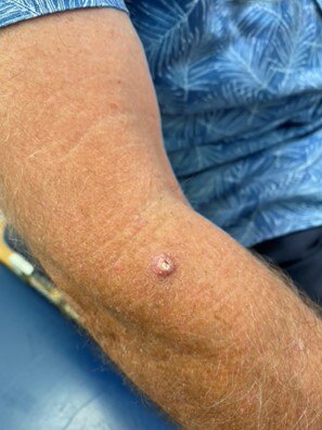 How would you manage this lesion on the elbow?