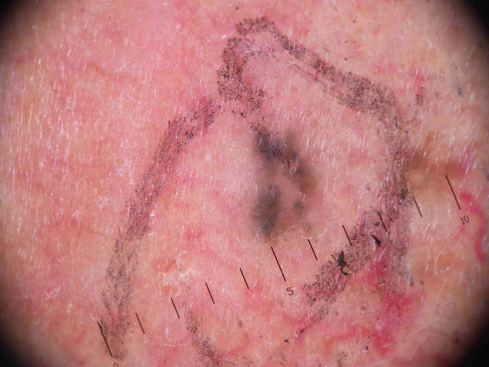 How would you manage these two lesions on the face?