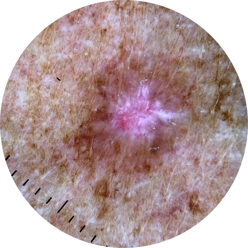 How would you diagnose this pink lesion on the back?