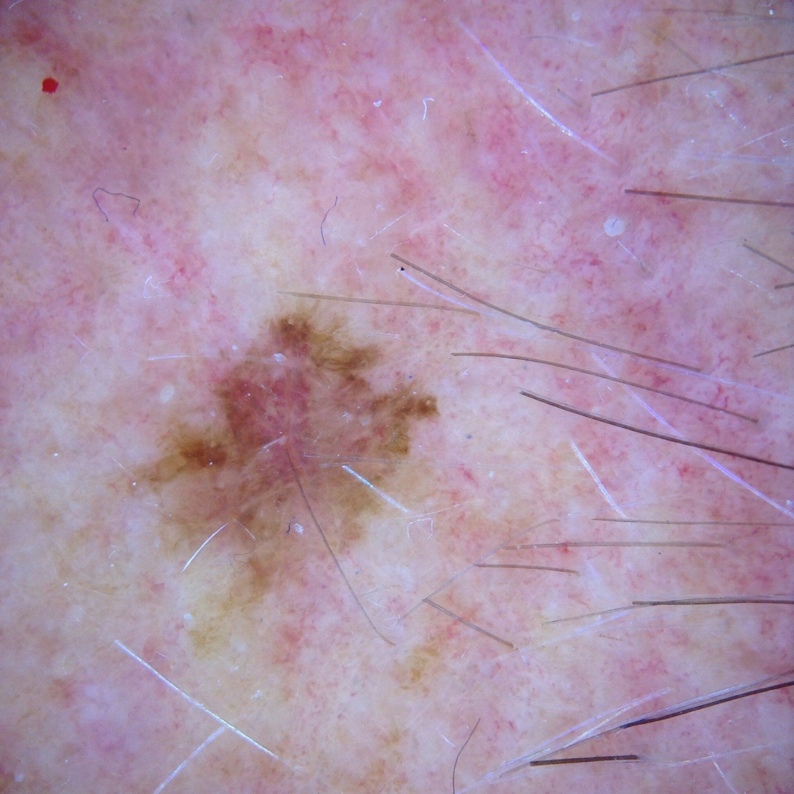 How would you manage this lesion on the back of the neck?