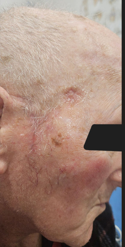 How would you manage this large lesion on the temple?