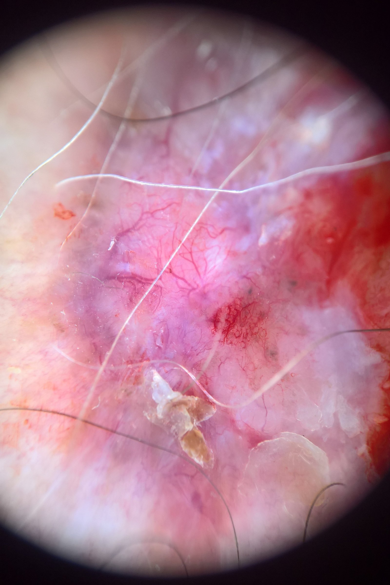 How would you manage this lesion on the chest?