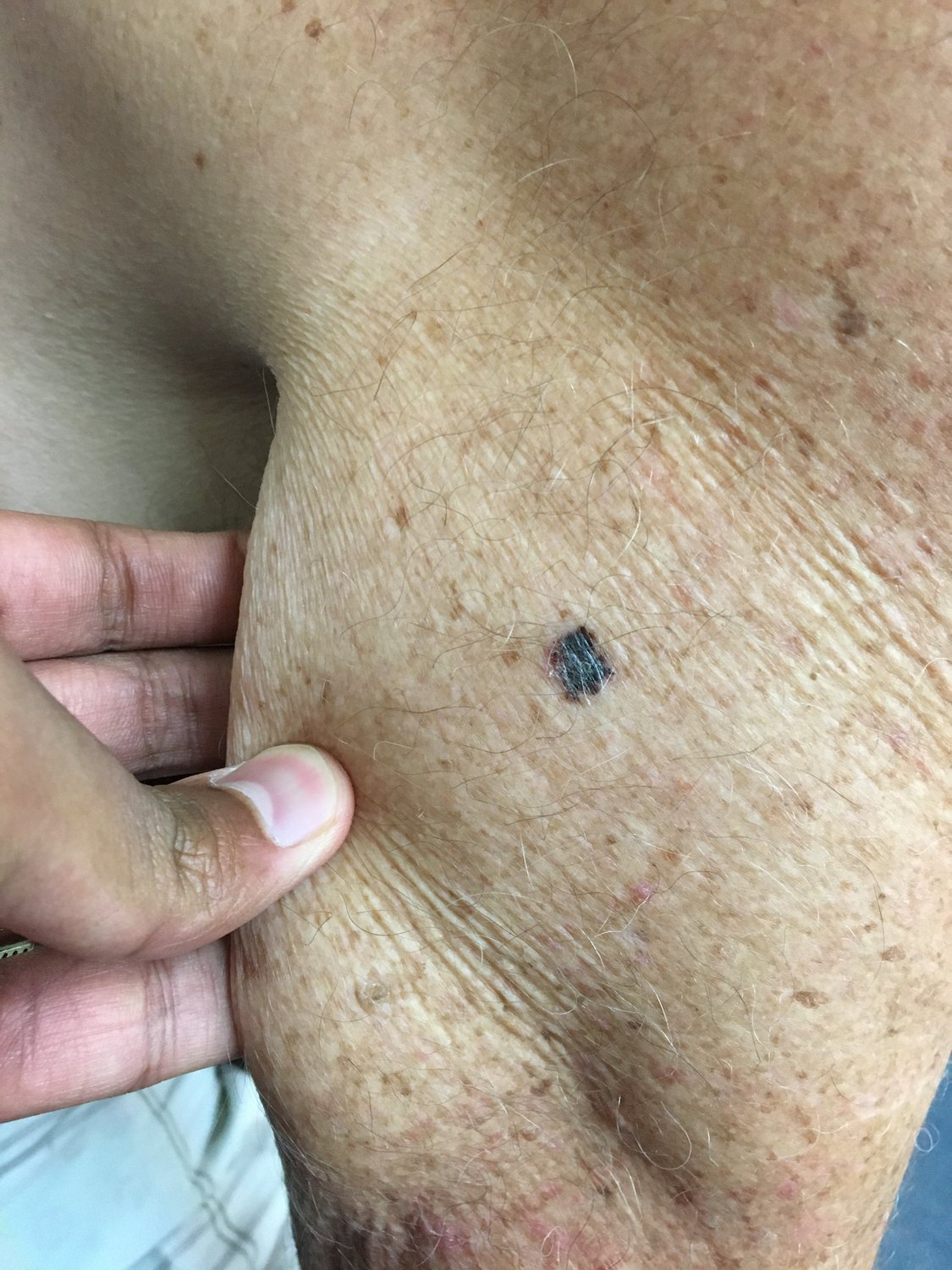 How would you manage this lesion on the back of the arm?