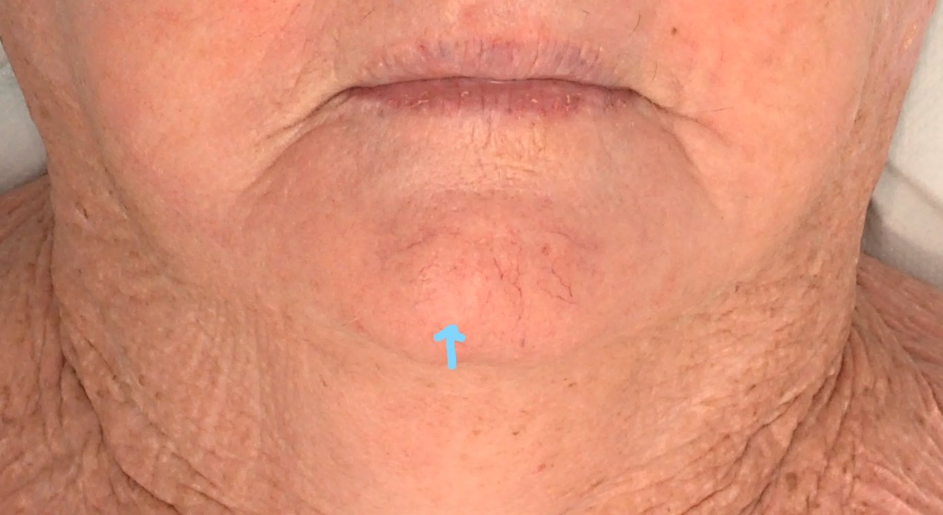 How would you treat this lesion on the chin?