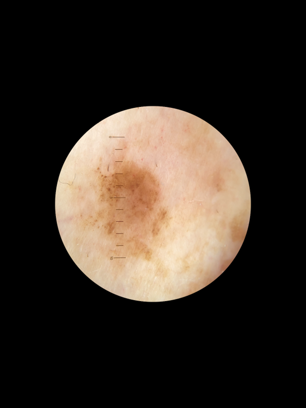 How would you treat this lesion on the lower leg?