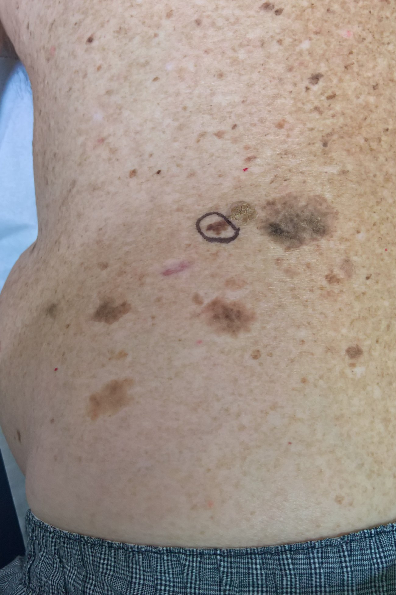 What do you think of this lesion on the loin?