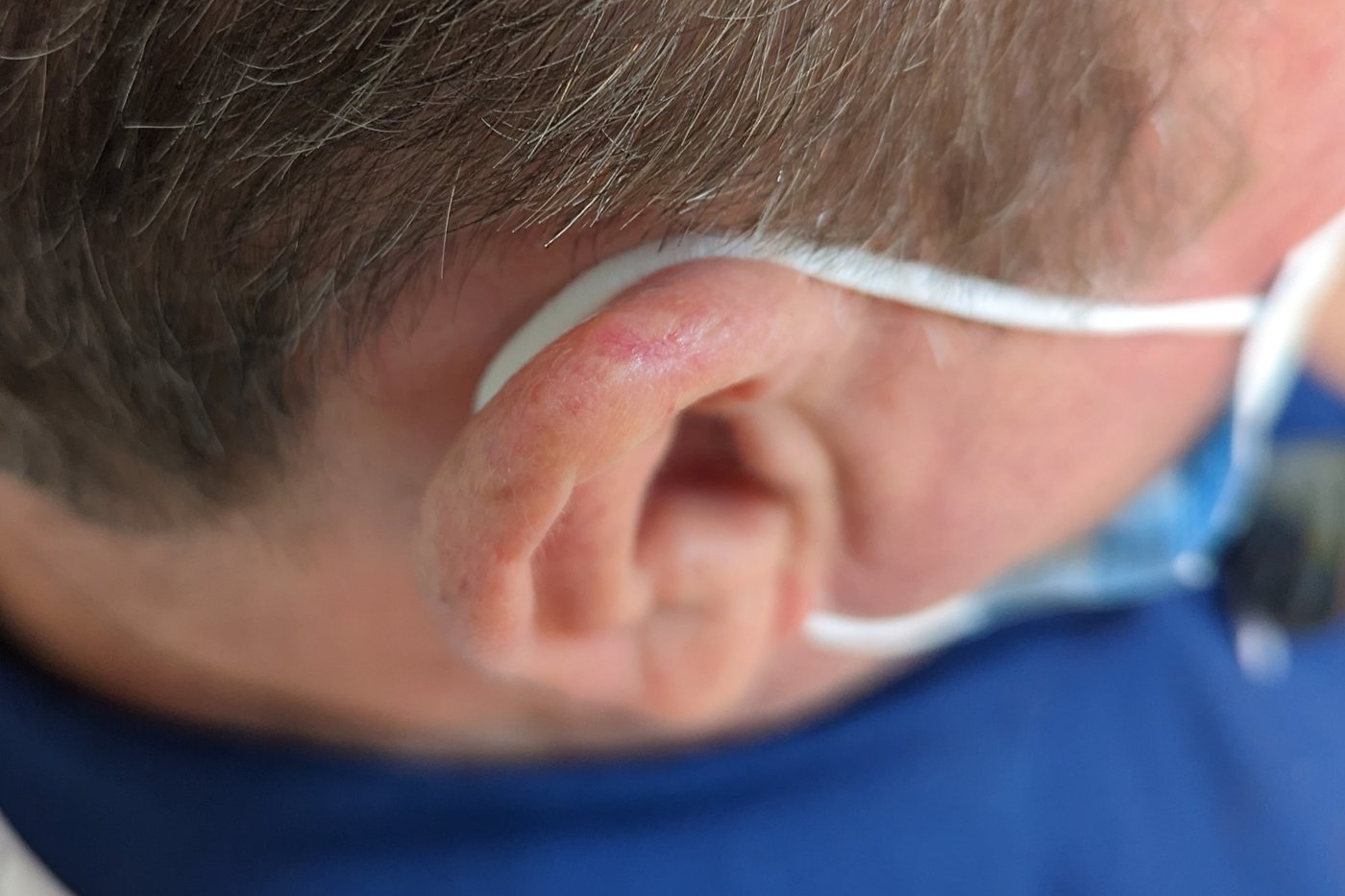 How would you manage this lesion on the helical rim?