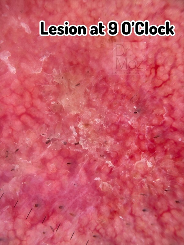 How would you manage this bleeding lesion?