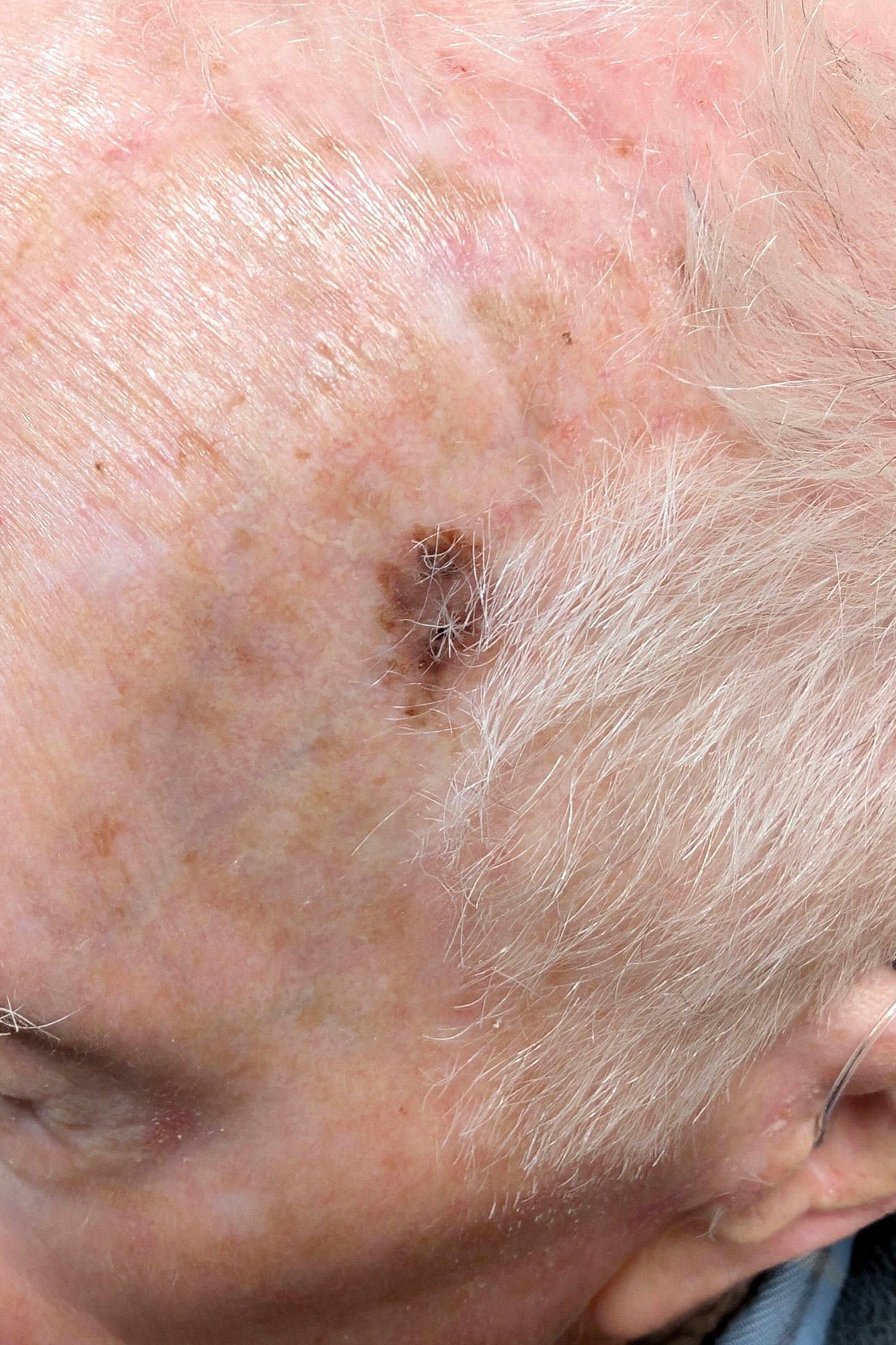 How would you manage this lesion on the temple?