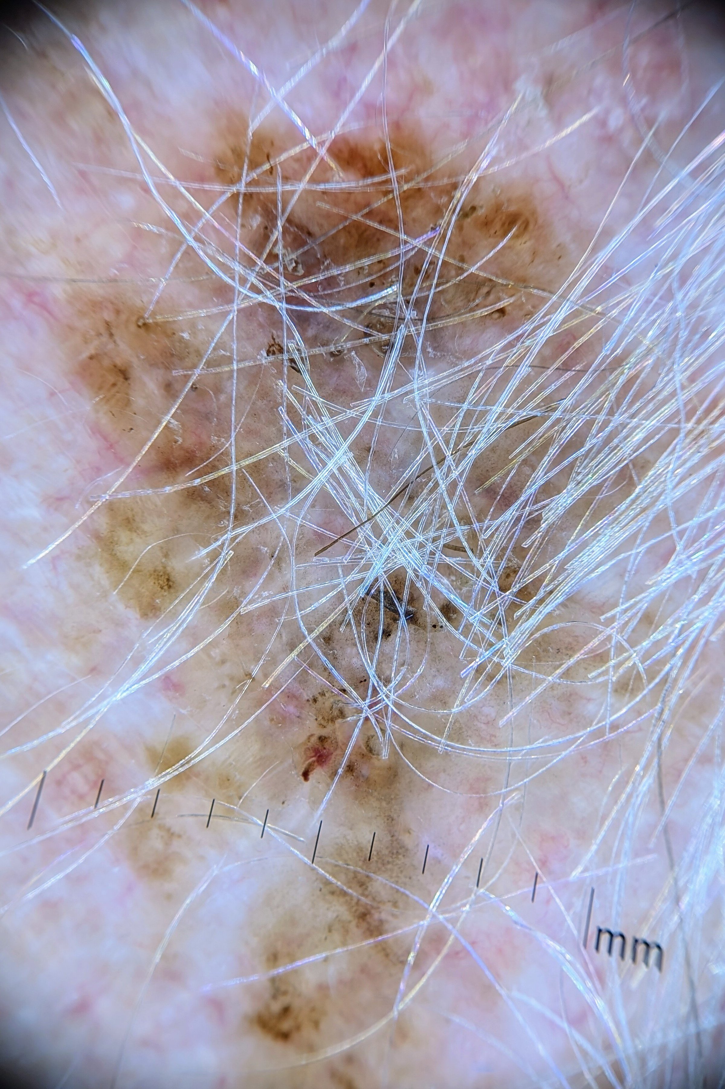 How would you manage this lesion on the temple?