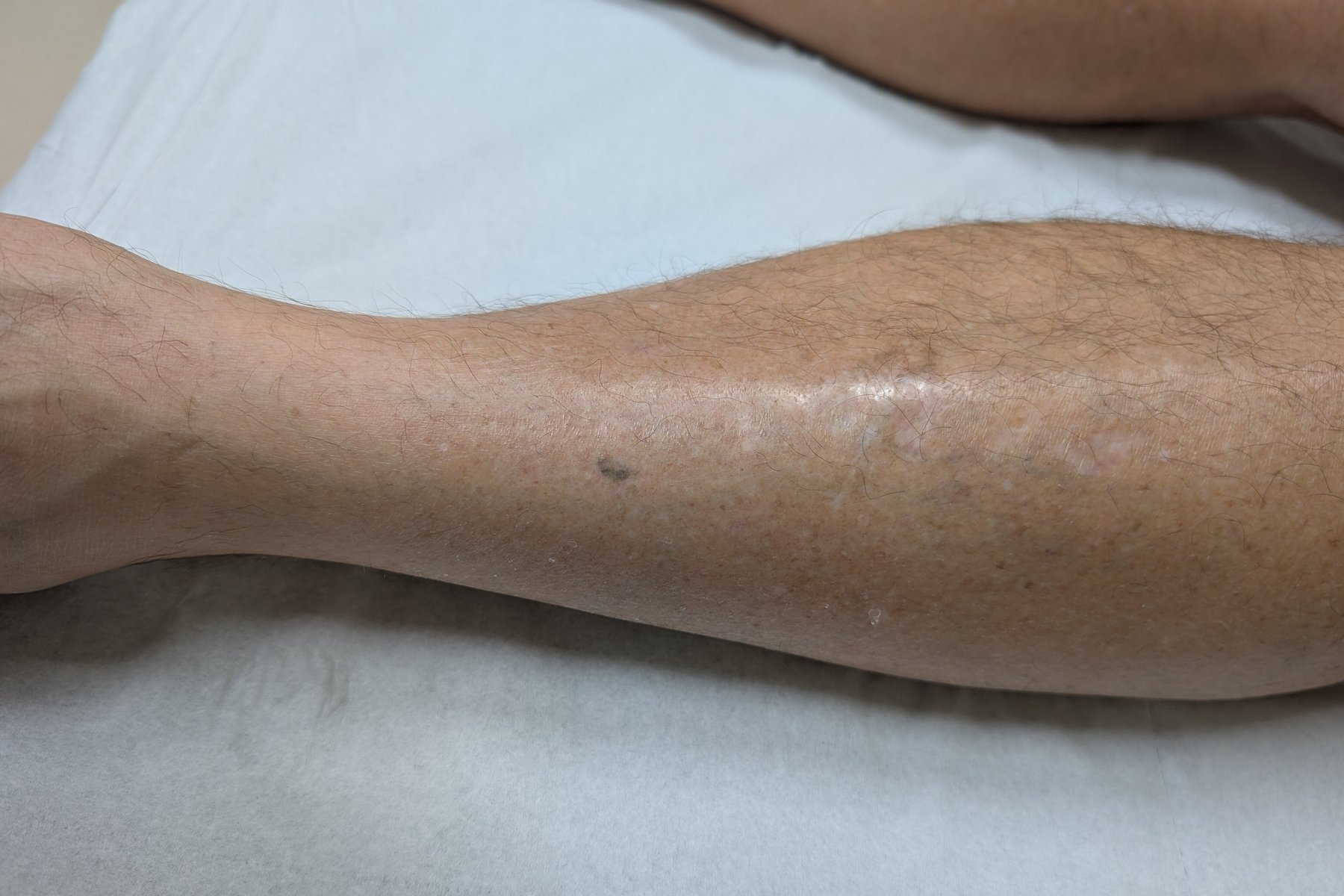 How would you manage this lesion on the shin?