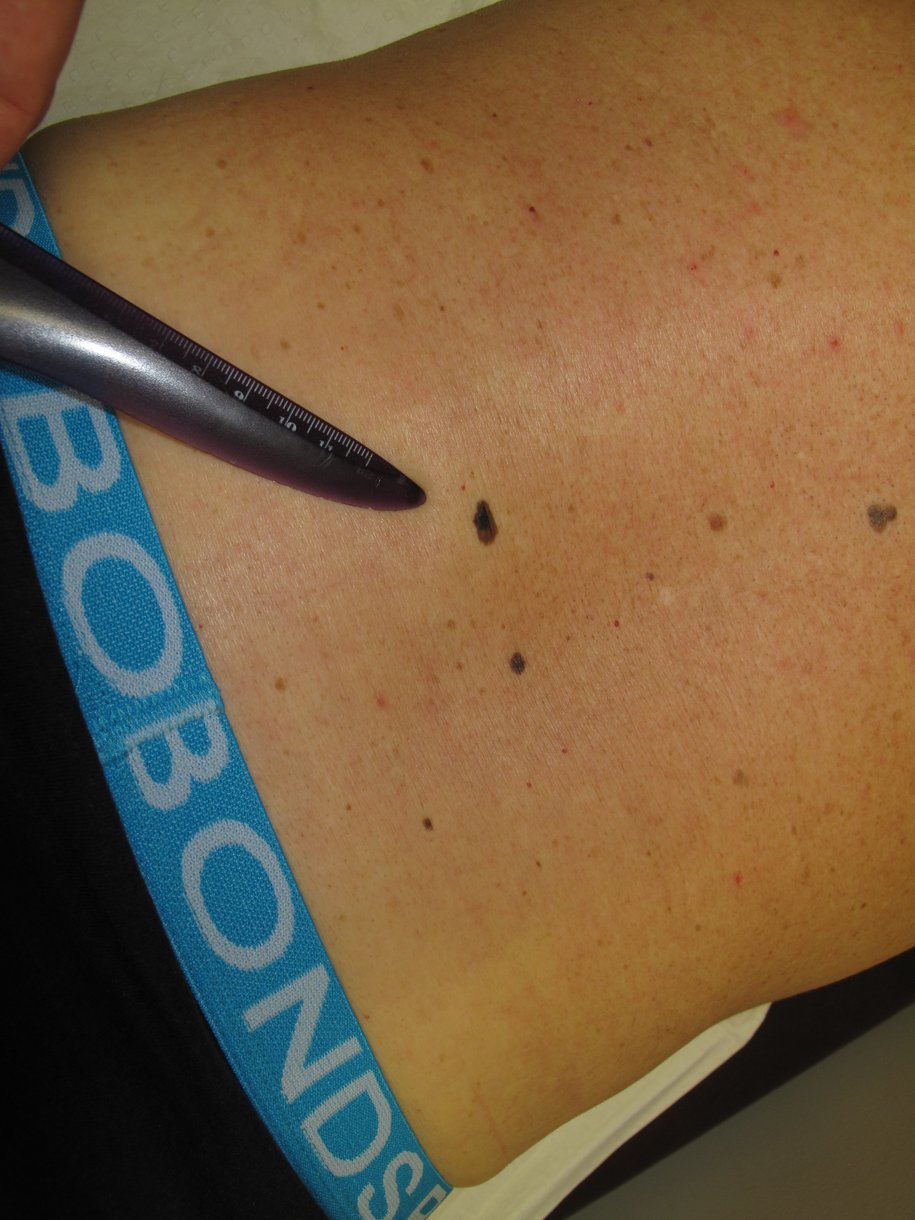 What do you think of this lesion on the lower back?