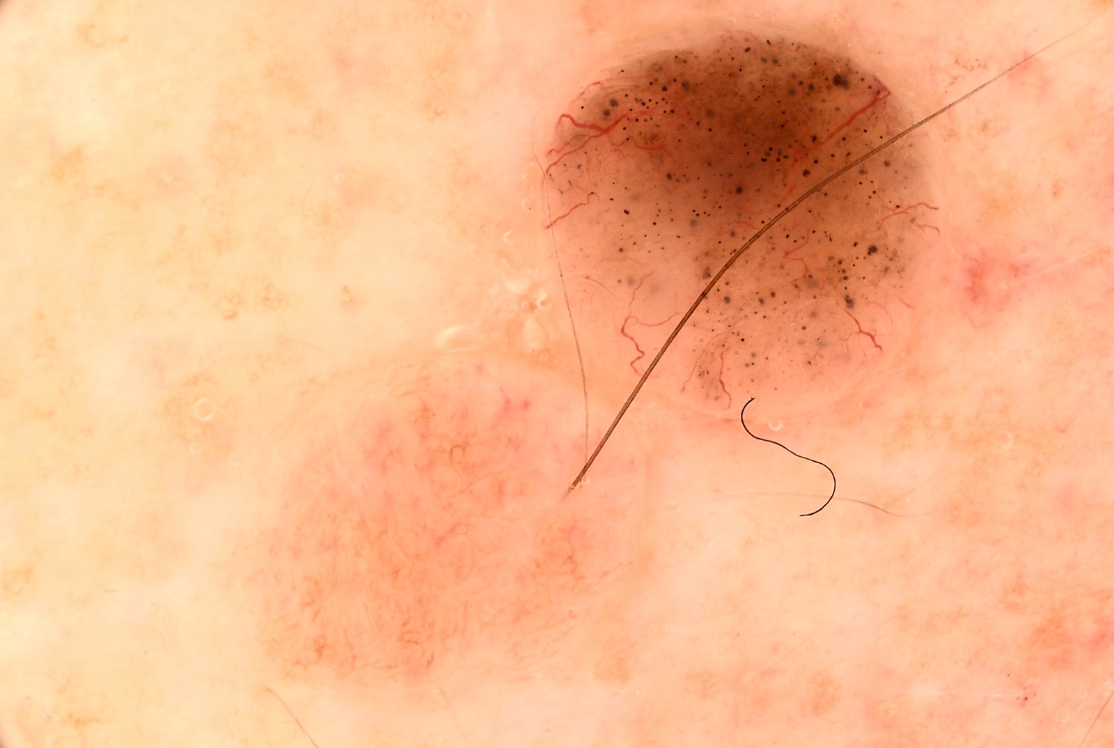 How would you differentiate these two facial lesions?