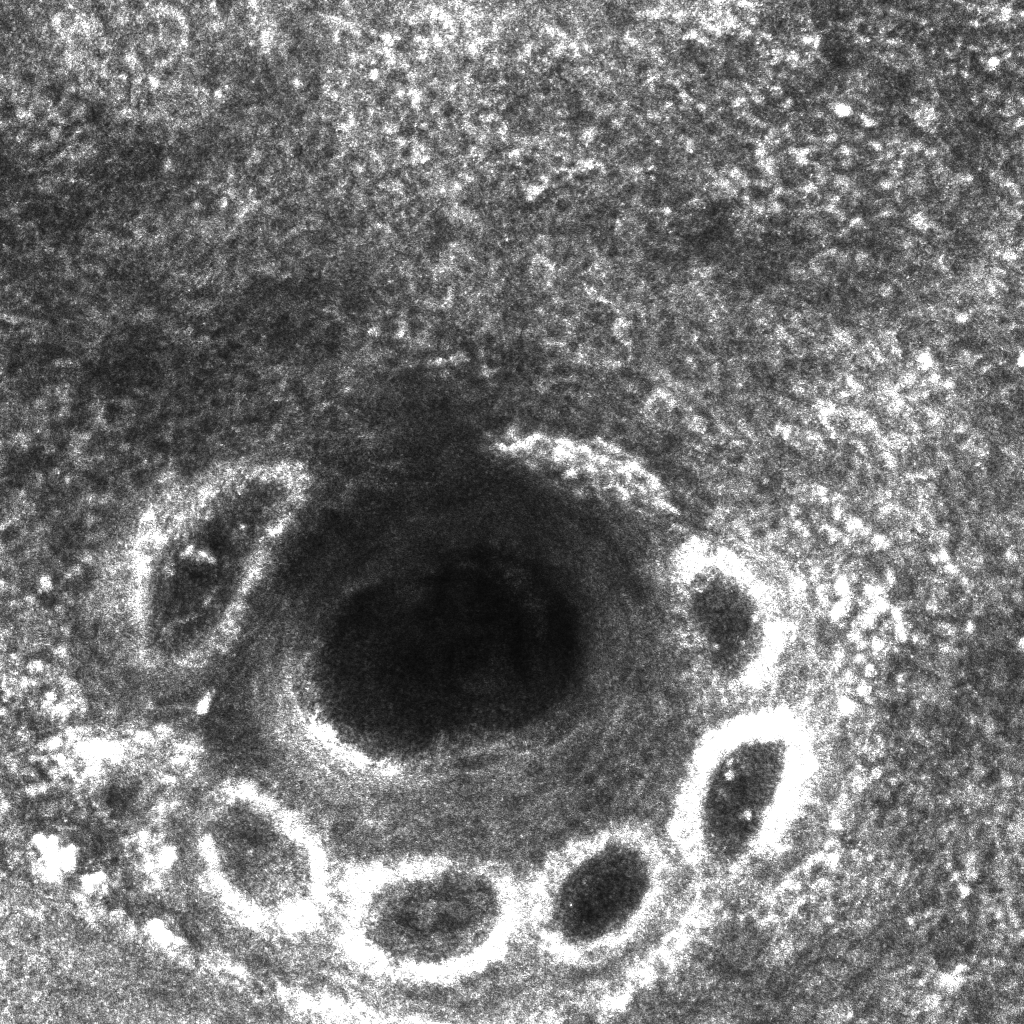 How would you manage this macule on the nose?