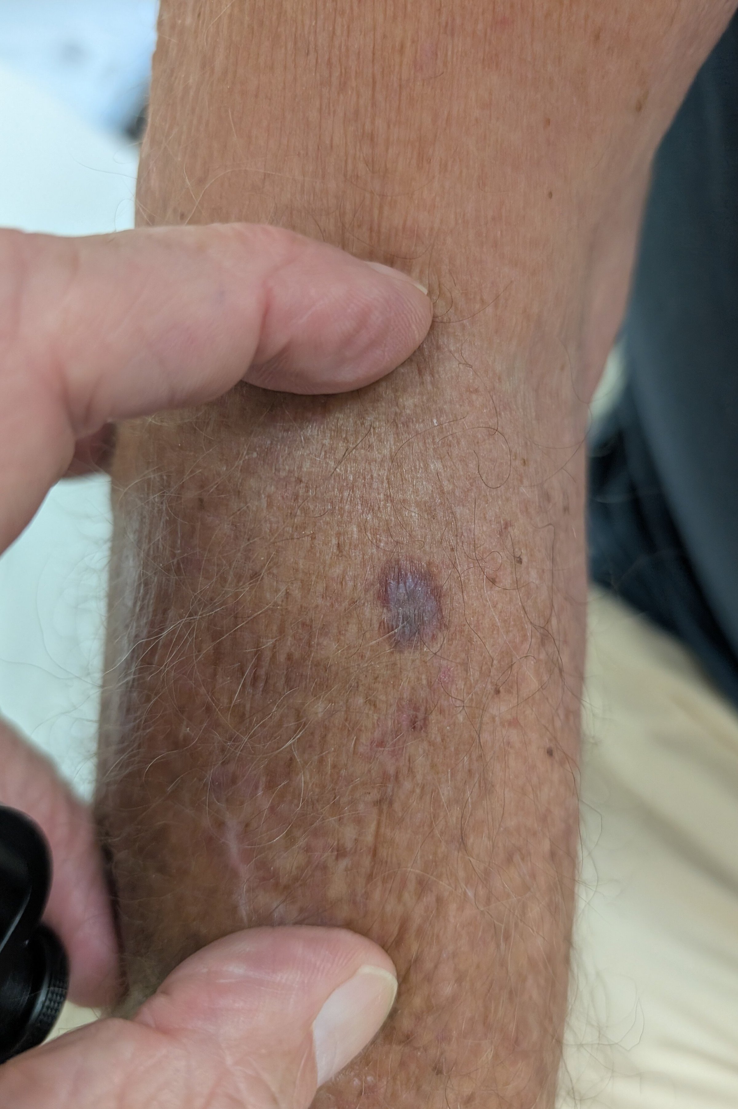 How would you manage this new lesion on the arm?