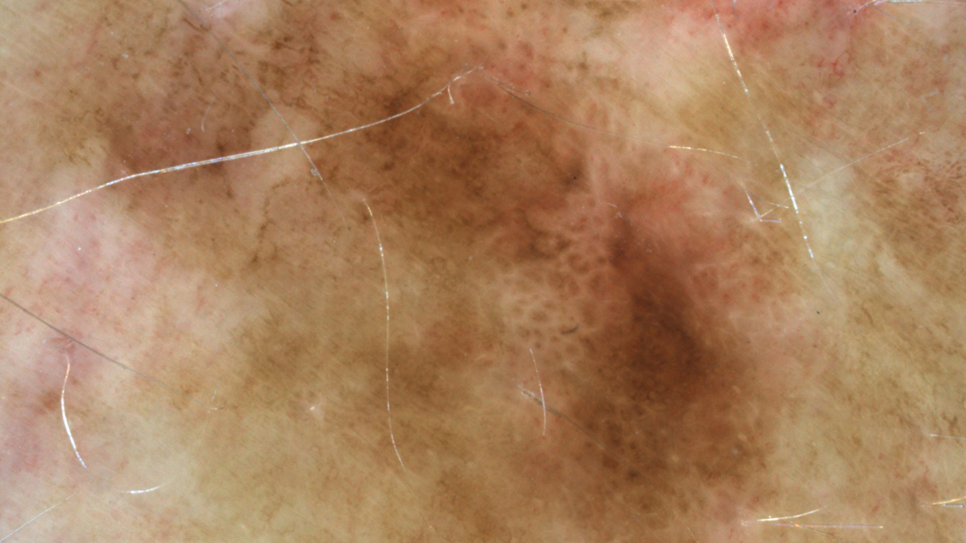 How would you treat this lesion on the left forearm?