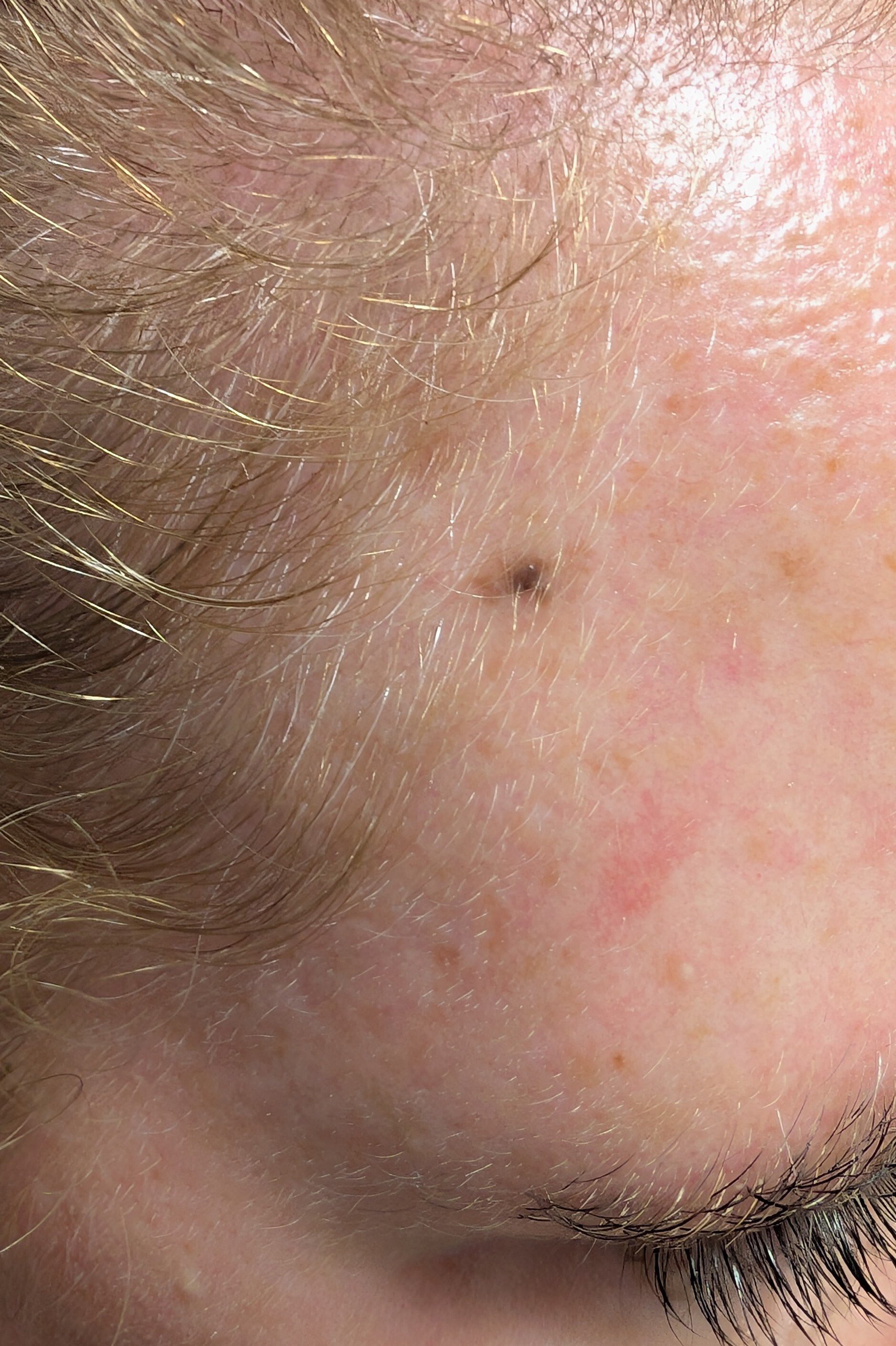 How would you manage this lesion on the temple?