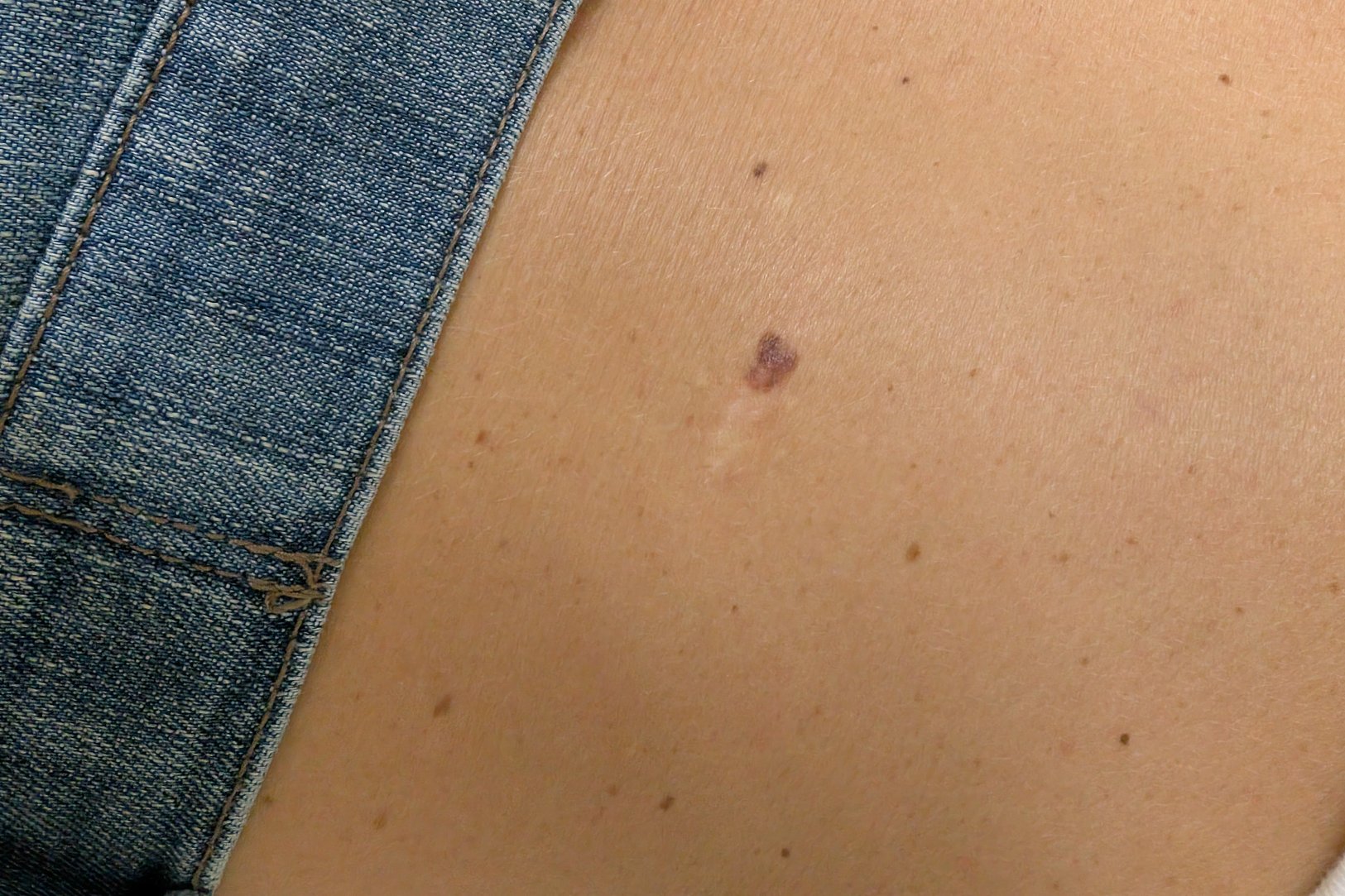 How would you manage this lesion arising at site of previous excision?