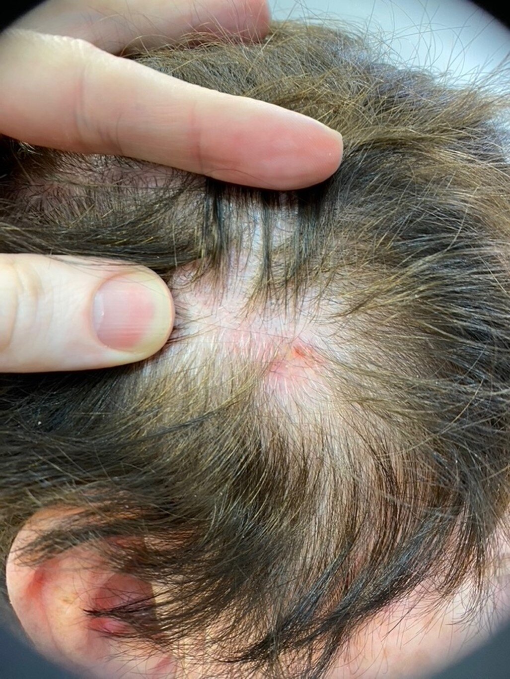 How would you manage this lesion on the scalp?