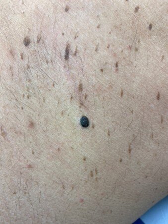 How would you manage this dark lesion on the back?
