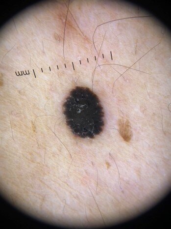 How would you manage this dark lesion on the back?