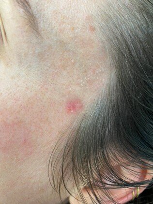 Dermatology case discussion: Scaly pink lesion on temple
