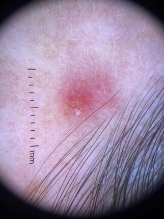 Dermatology case discussion: Scaly pink lesion on temple