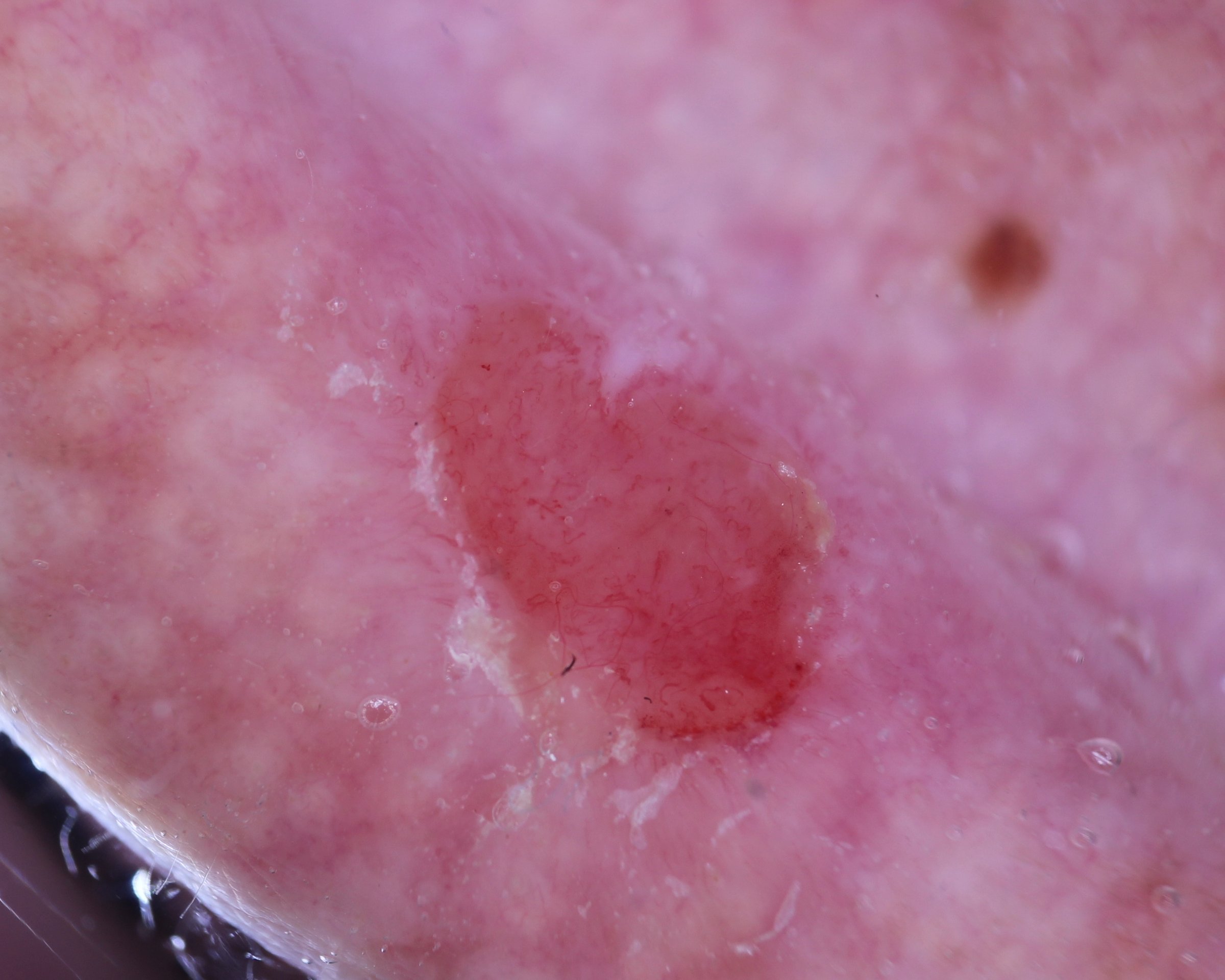 How would you manage this ulcer on the ear?
