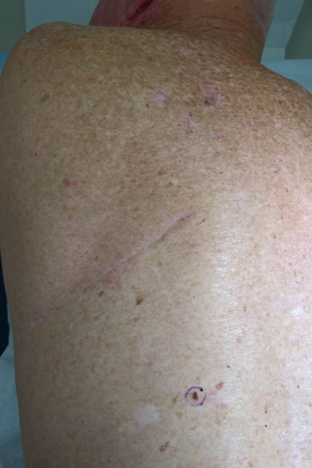 How would you treat this lesion on the loin?