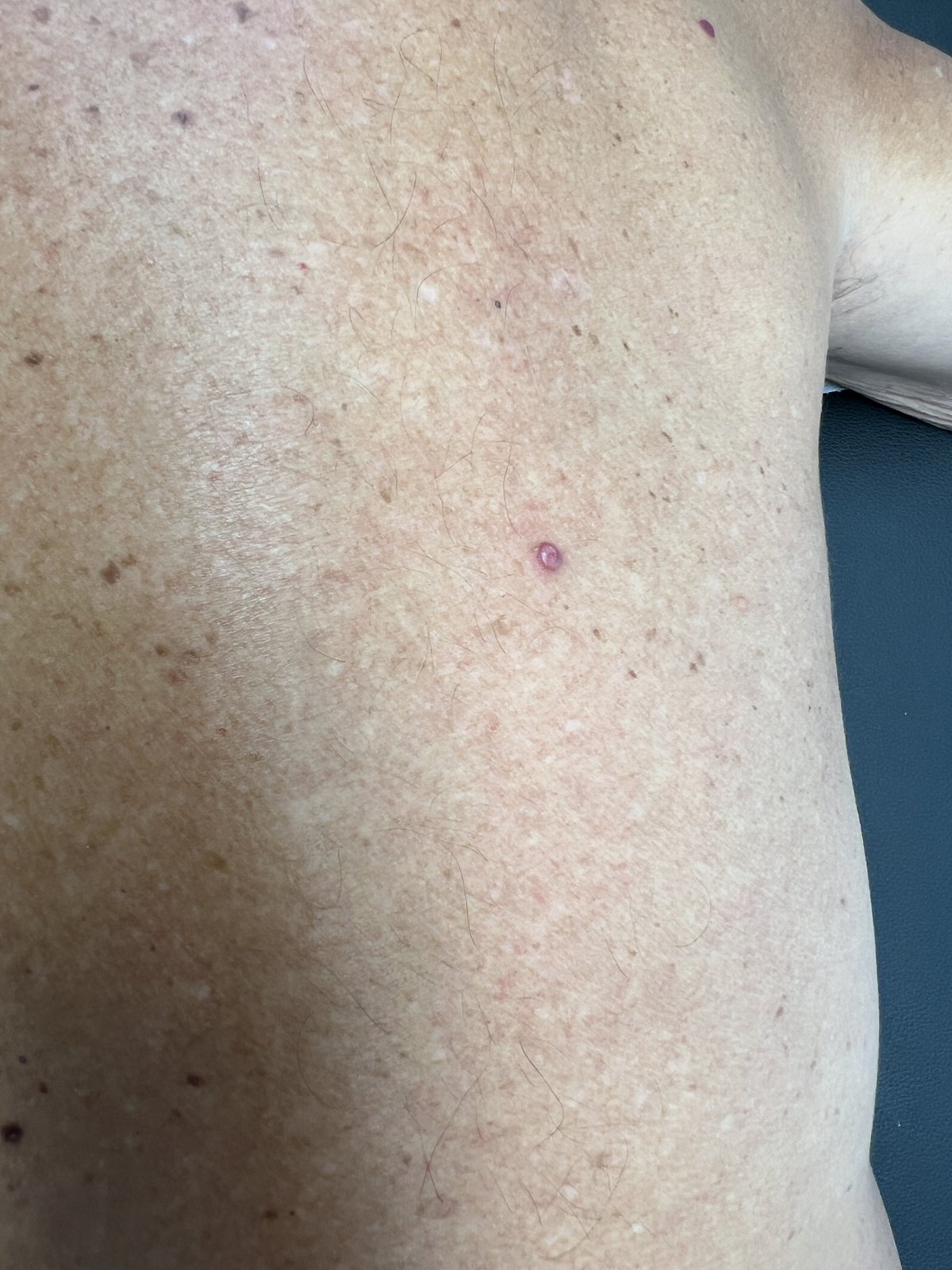 How would you manage this pink lesion on the back?