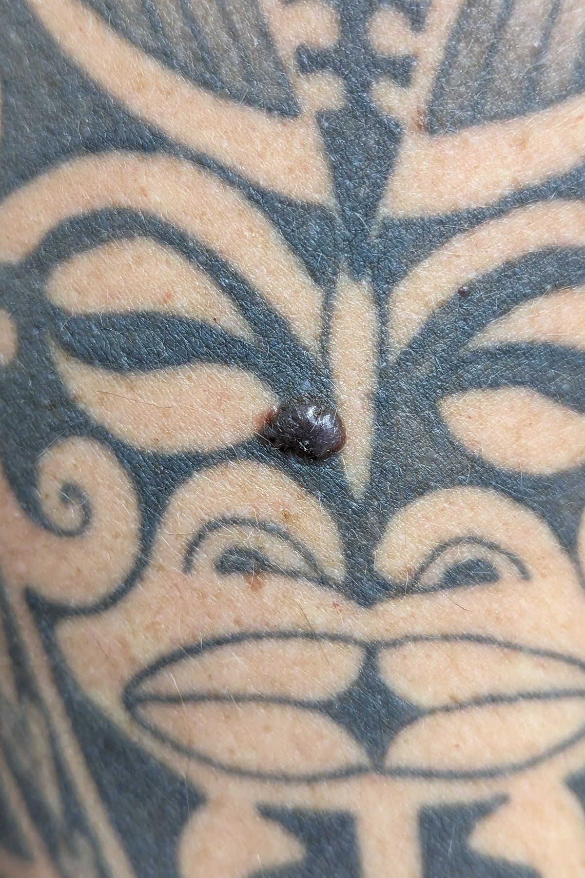 How would you treat this lesion in a tattoo?