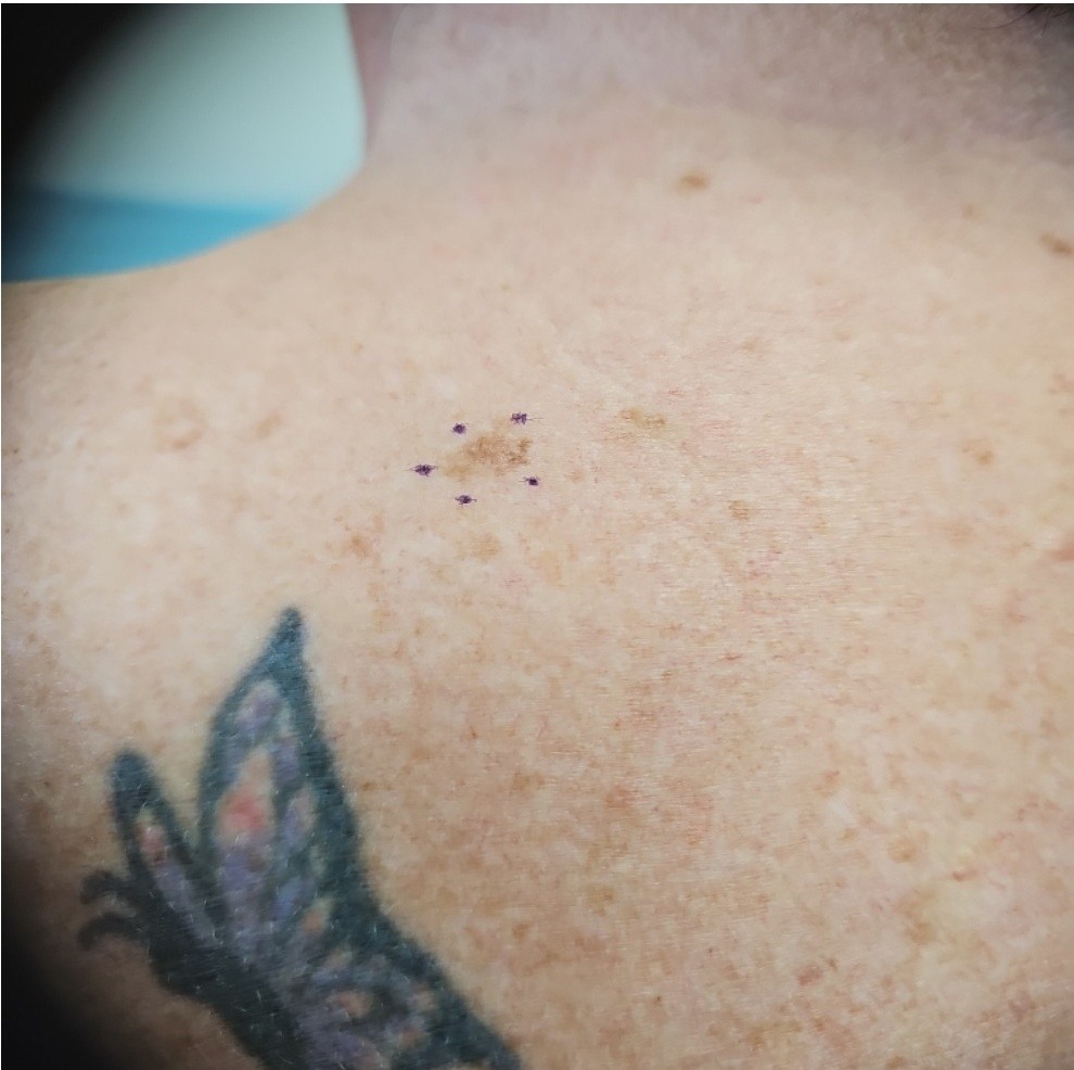 How would you manage this lesion on a woman's back?