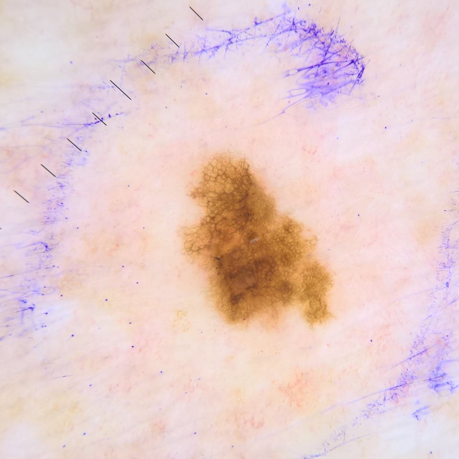 How would you treat this lesion on the loin?