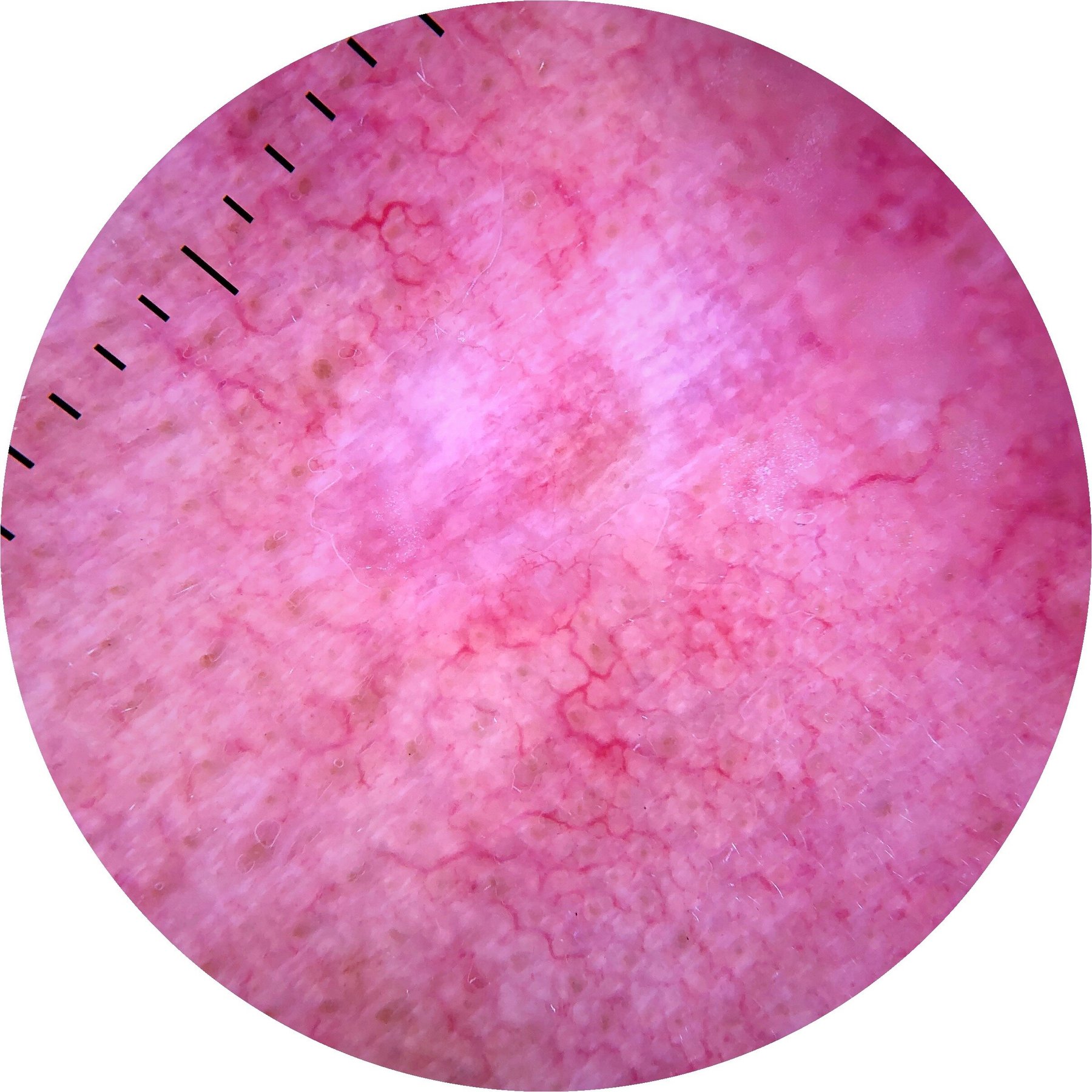 How would you manage this scar-like lesion on the face?