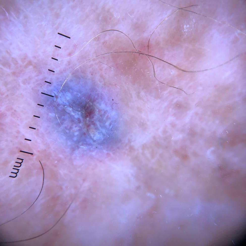 How would you manage this lesion on the shin?