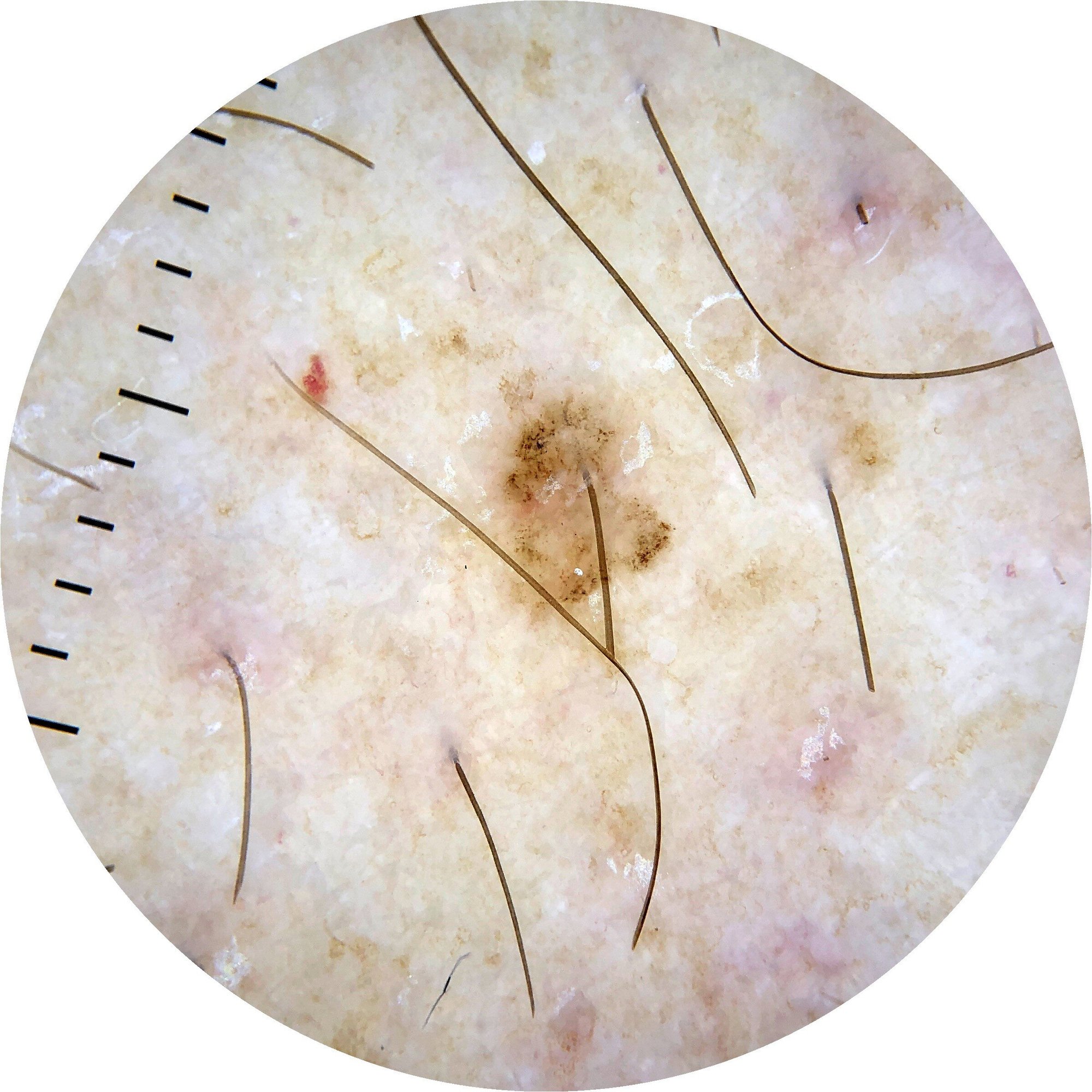 How would you manage this regressing lesion on the shin?