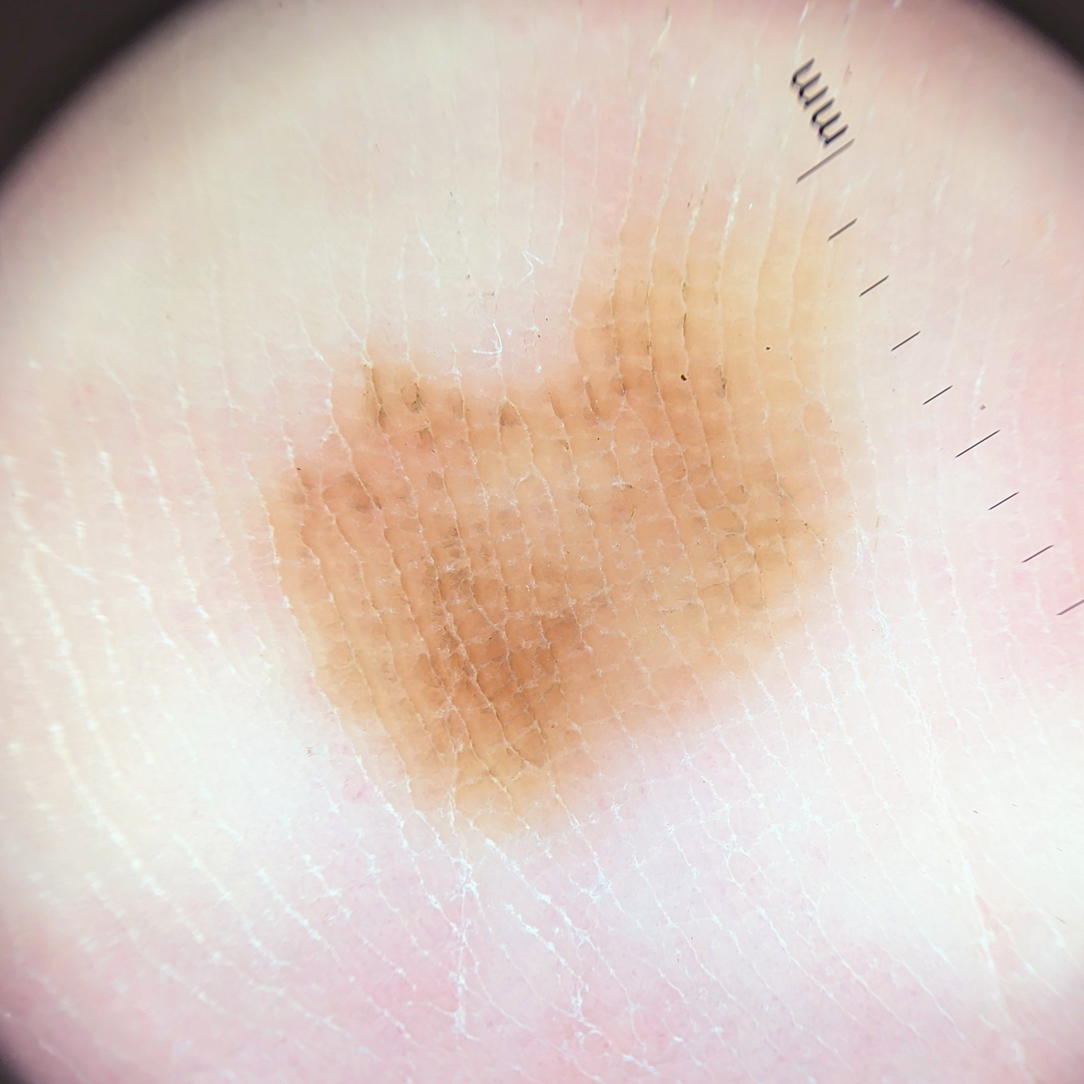 How would you treat this lesion on the sole of the foot?