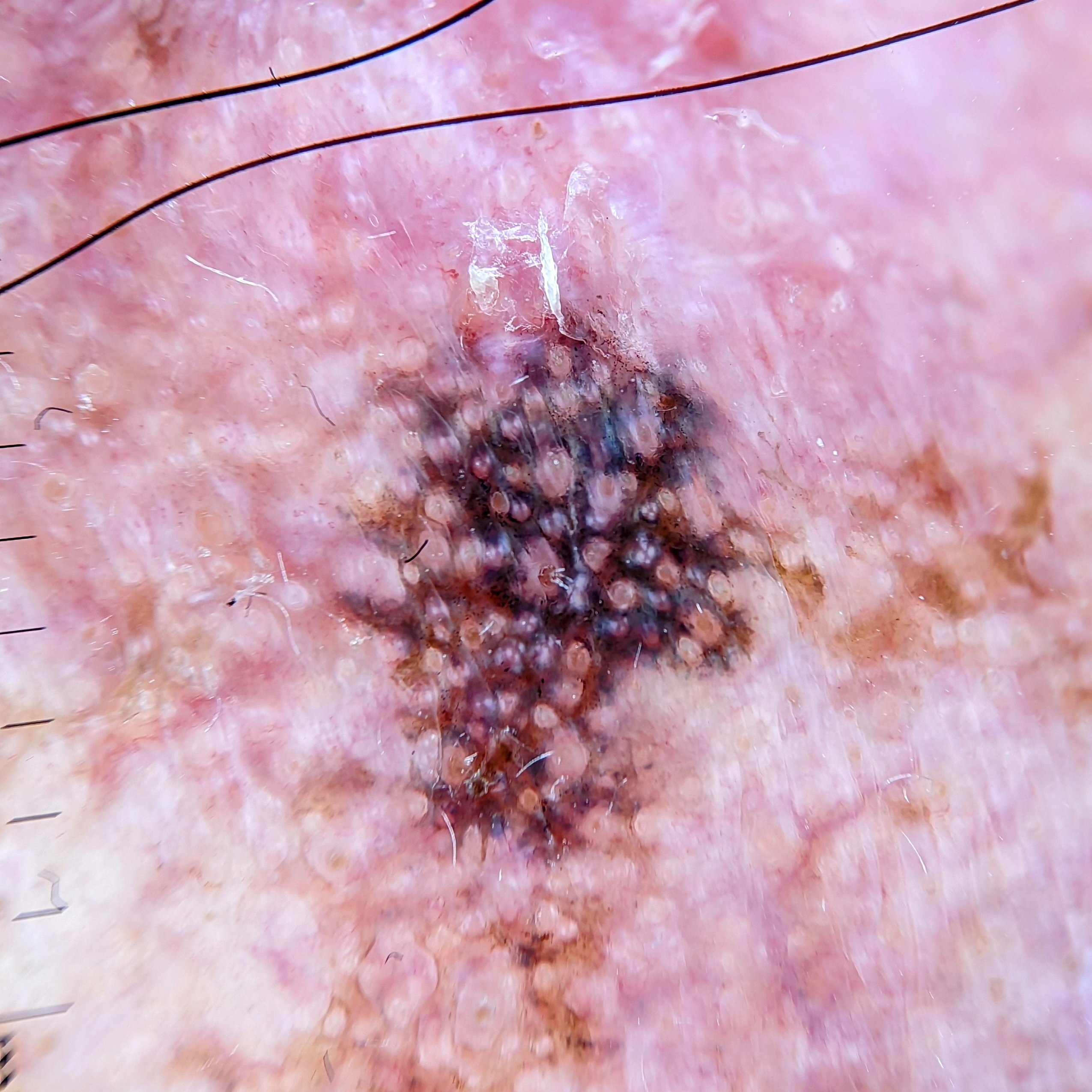 How would you manage this lesion on the forehead?